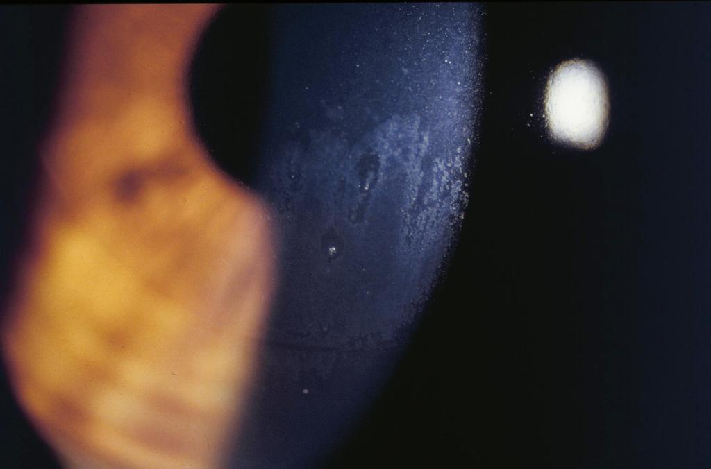 Contact Lens Deposition - mivision