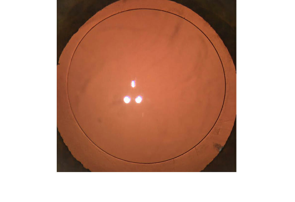 New Patient Interface Improves Laser Refractive Cataract Surgery - mivision