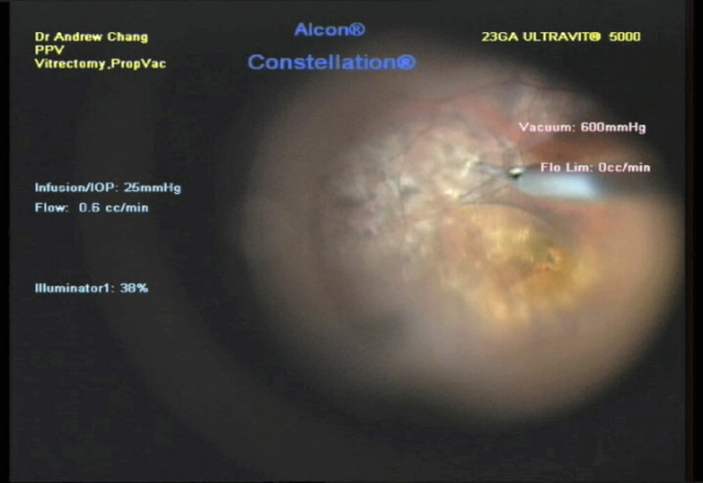 Understanding Myopic Tractional Maculopathy - mivision