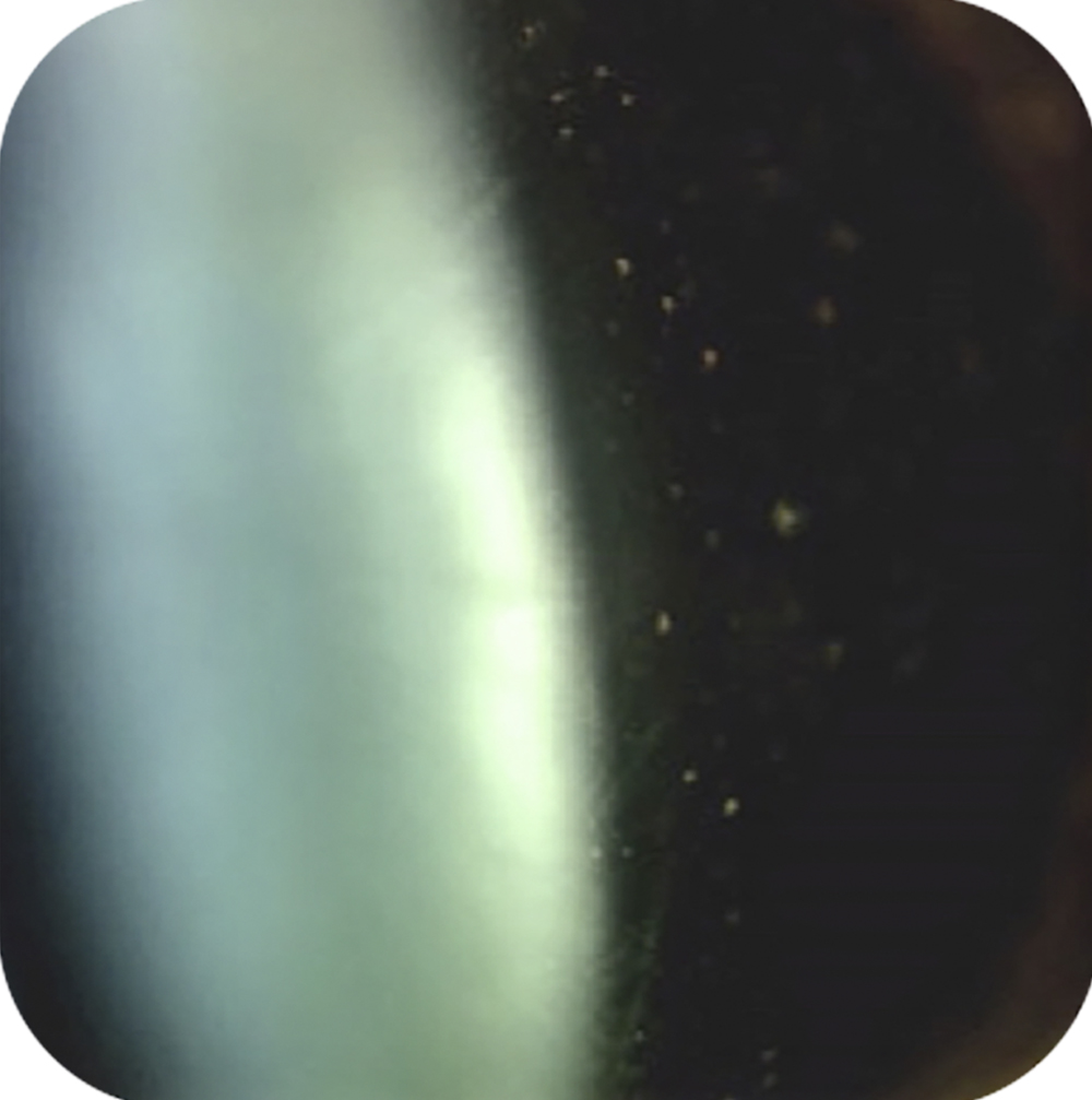 Epiretinal Membrane – A Practical Review - mivision